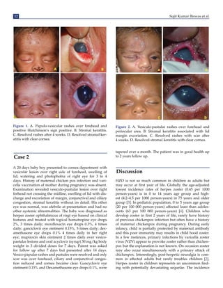 Neonatal Herpes Zoster Ophthalmicus: Two Rare Cases | PDF