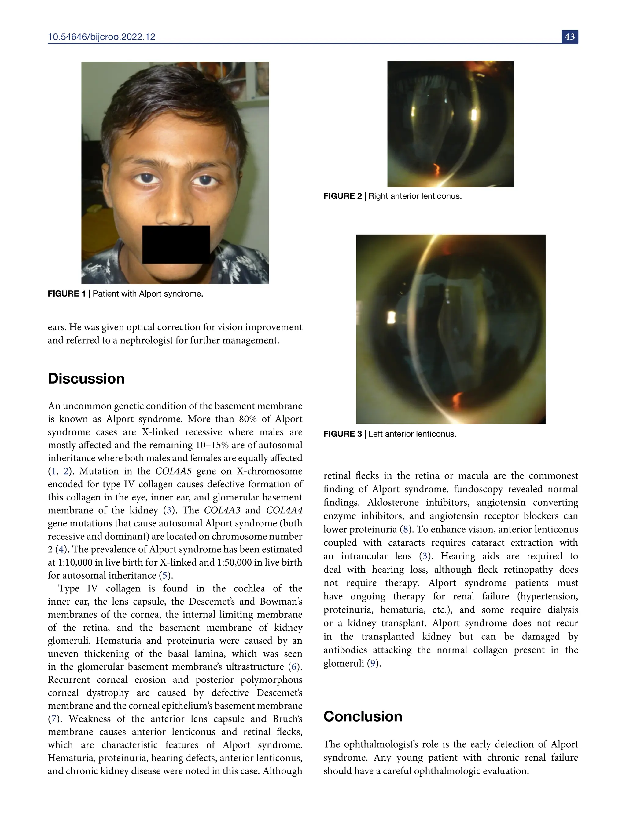 A case of Alport syndrome presented with bilateral anterior lenticonus ...