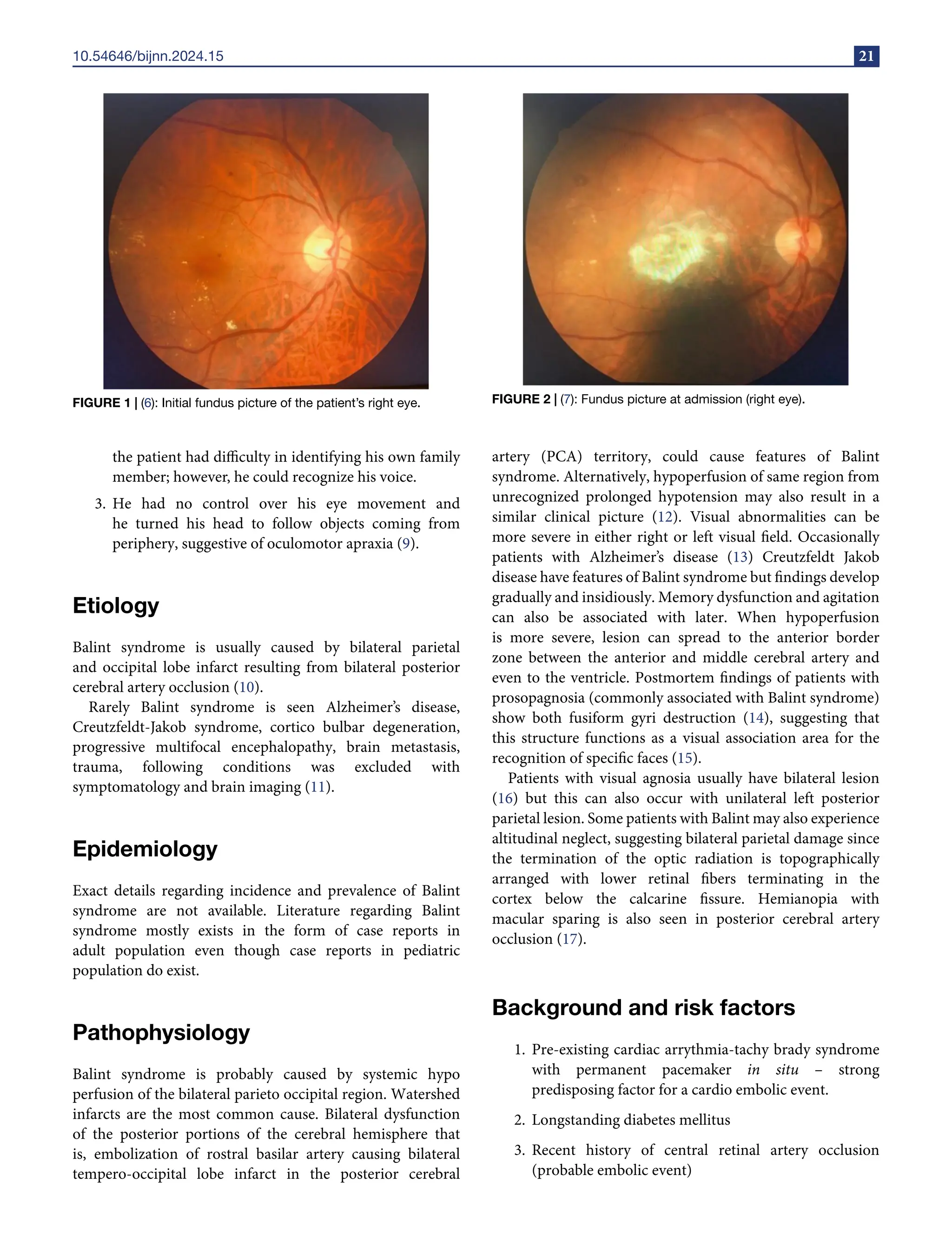 Balint syndrome: an unusual triad, Balint syndrome: an unusual triad | PDF
