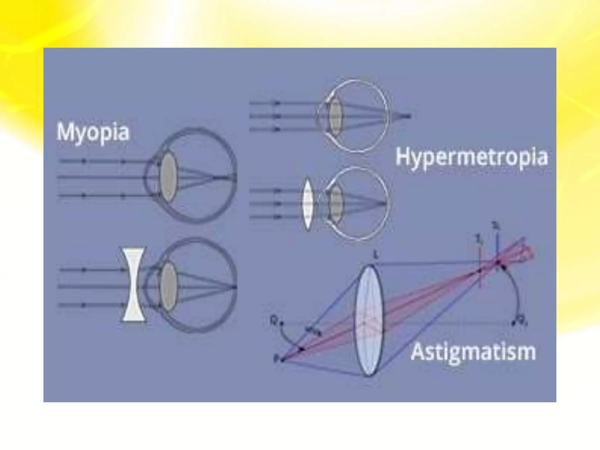Retinoscopy/ Objective Refraction / Retinoscopy of eye (Principle ...