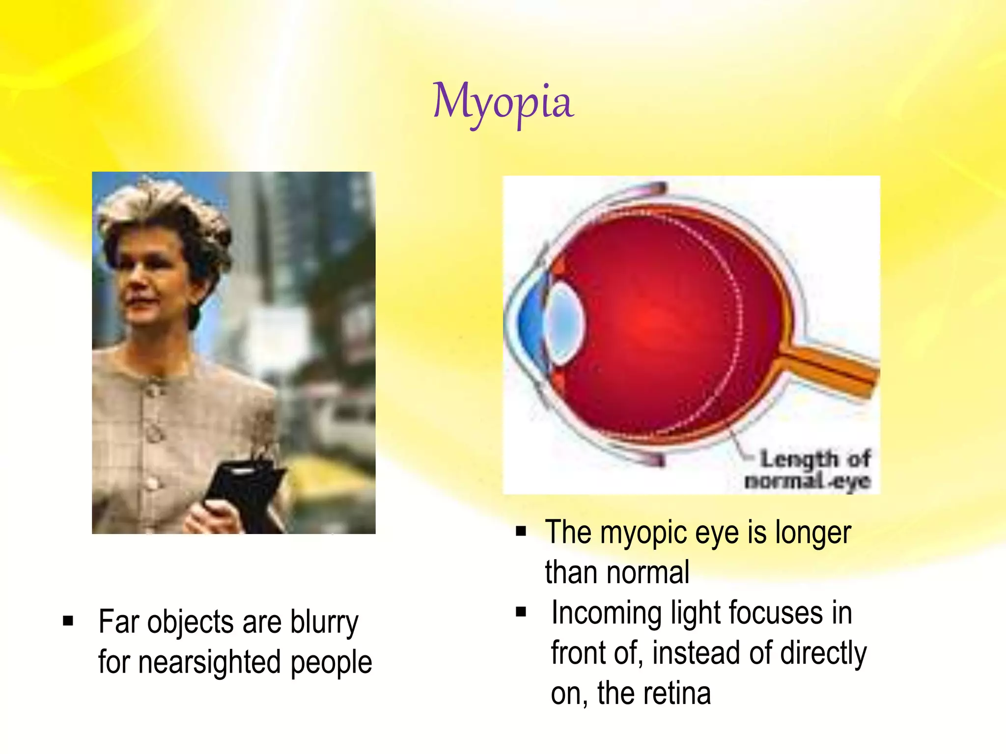Retinoscopy/ Objective Refraction / Retinoscopy of eye (Principle ...