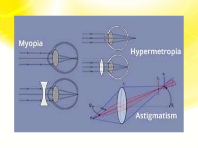 Retinoscopy/ Objective Refraction / Retinoscopy of eye (Principle ...