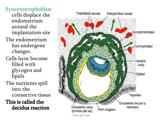 Bilaminar germ disc presentation