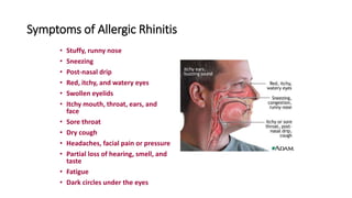 Bilastine Medical Part-1.pptx