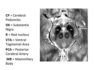 Subthalamic Nucleus Mri