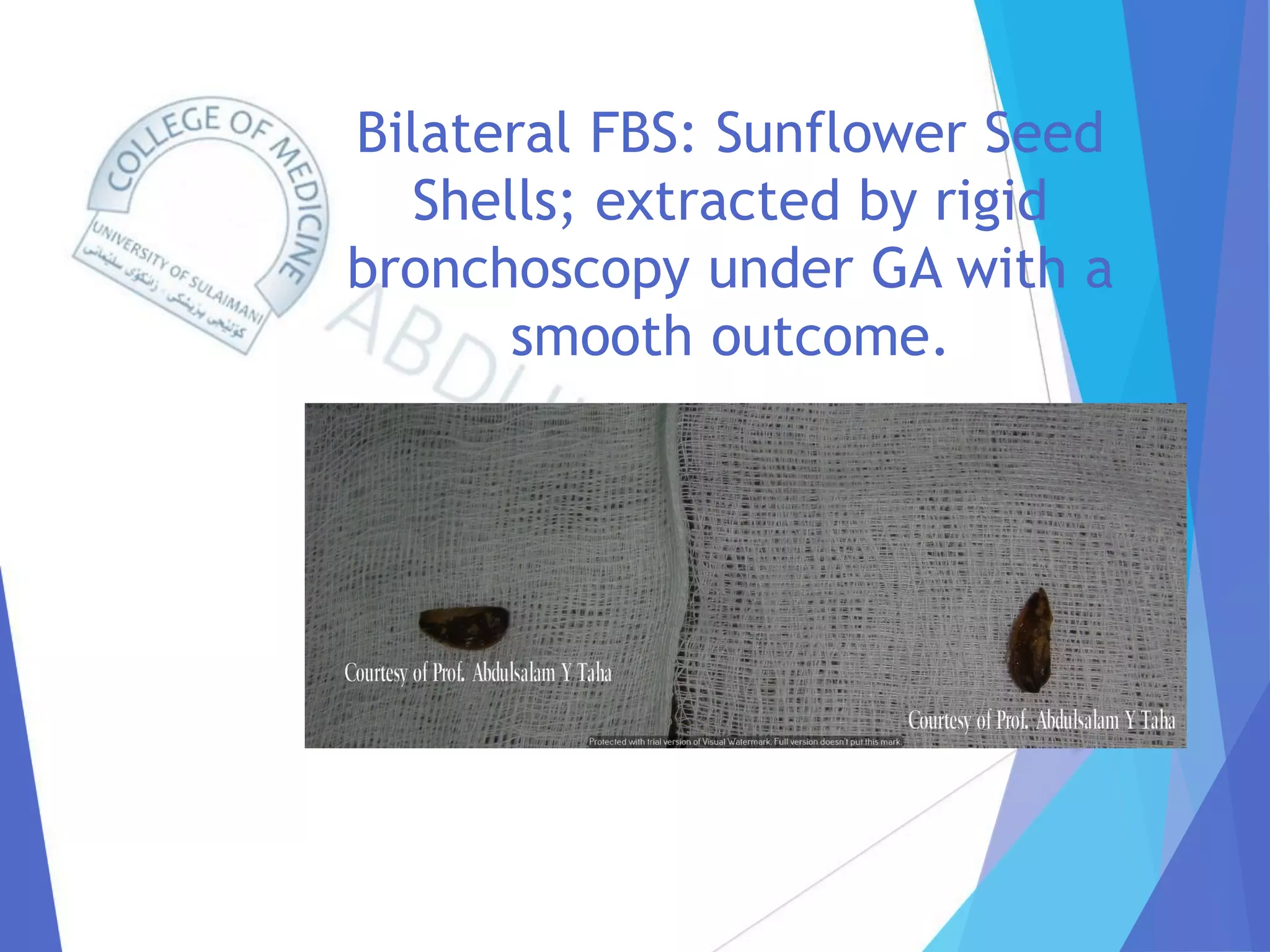 Bilateral Aspirated Foreign Bodies.pdf