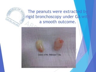 Bilateral Aspirated Foreign Bodies (Peanuts).pdf