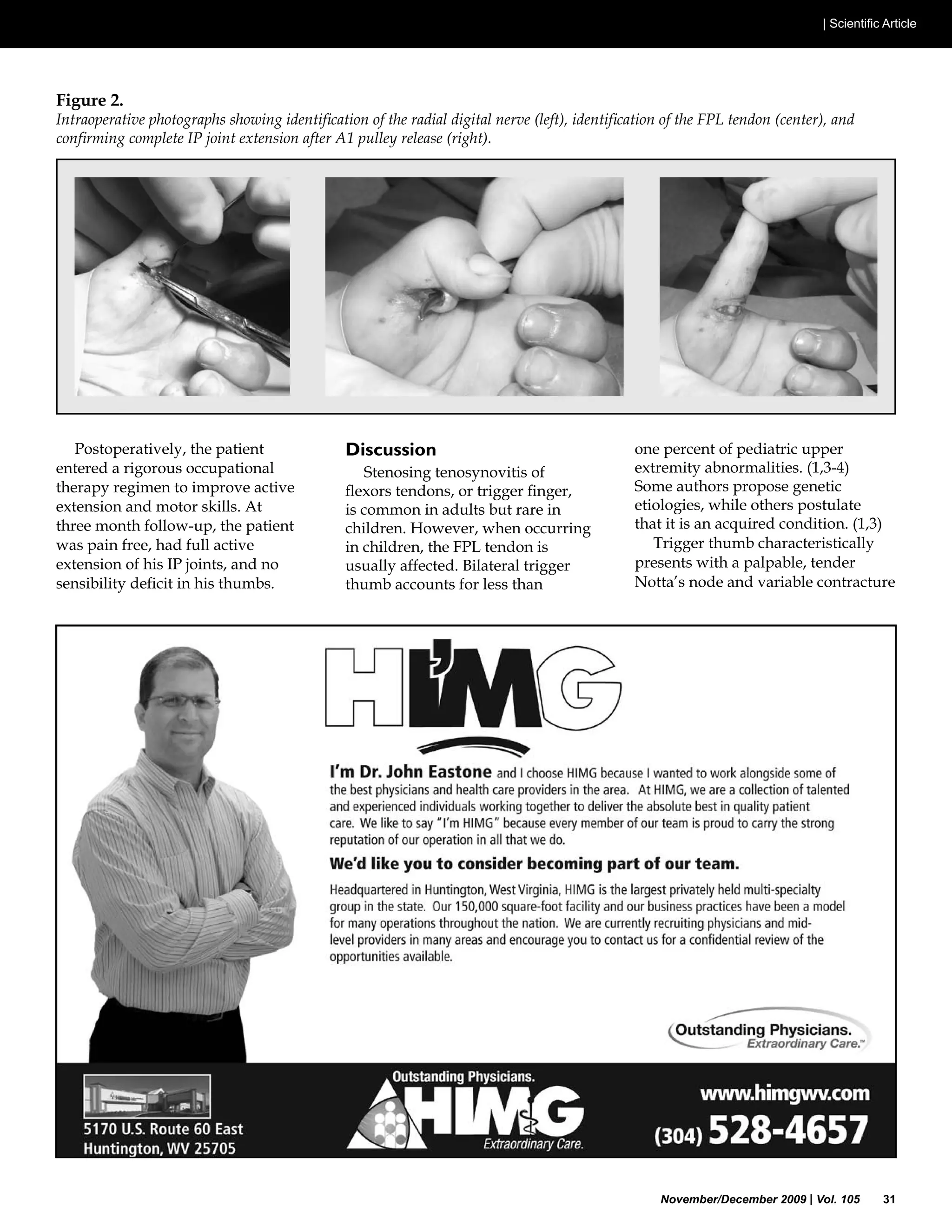 Bilateral Congenital Trigger Thumb | PDF