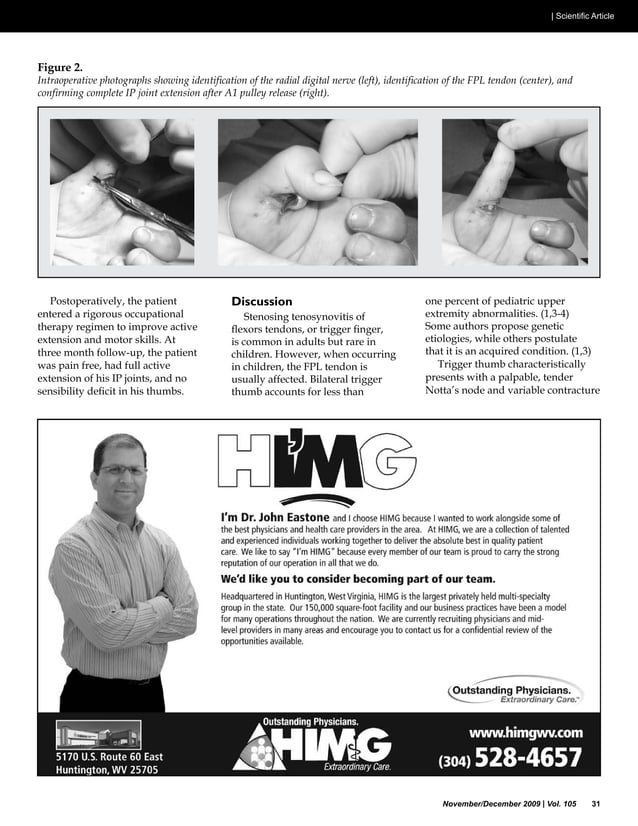 Bilateral Congenital Trigger Thumb | PDF