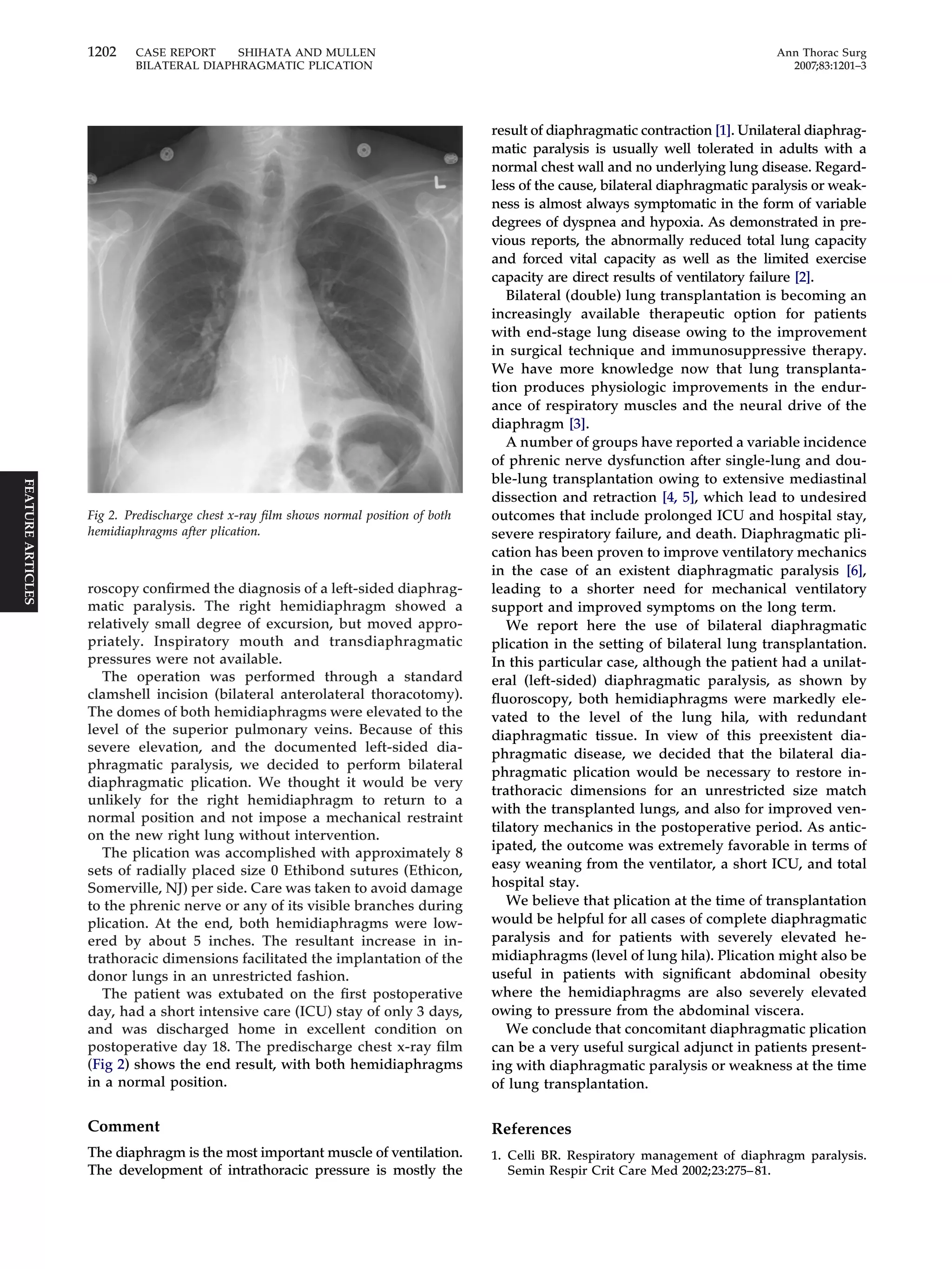 Bilateral diaphragm plication prior to transplantation | PDF
