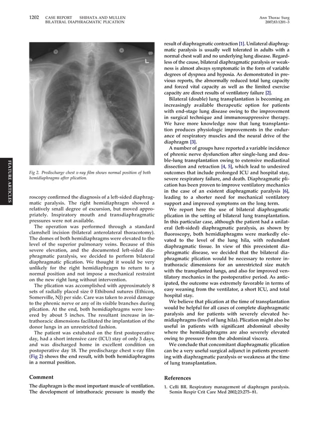 Bilateral diaphragm plication prior to transplantation | PDF