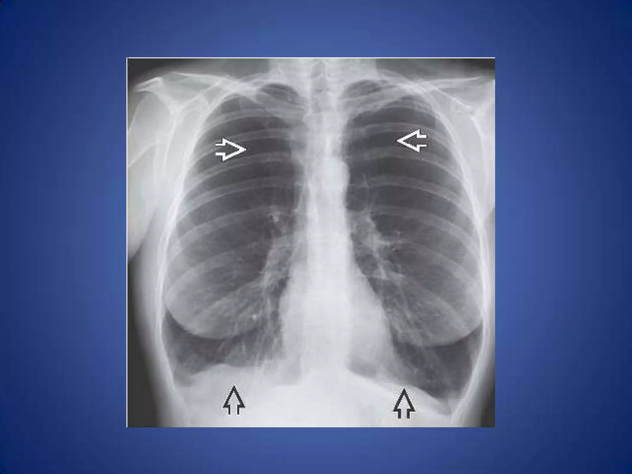 Bilateral hyperlucent hemithorax | PDF