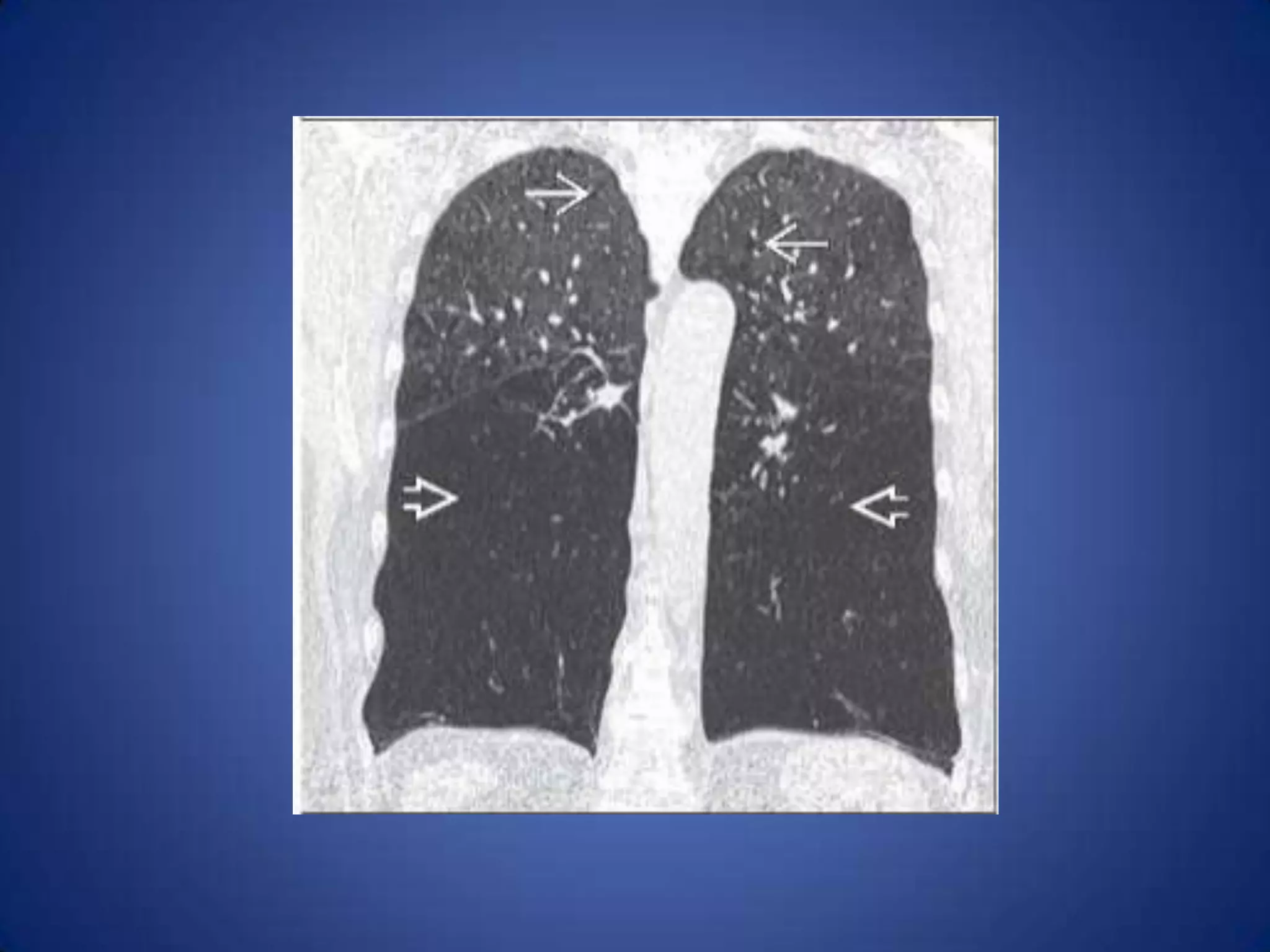 Bilateral hyperlucent hemithorax | PDF