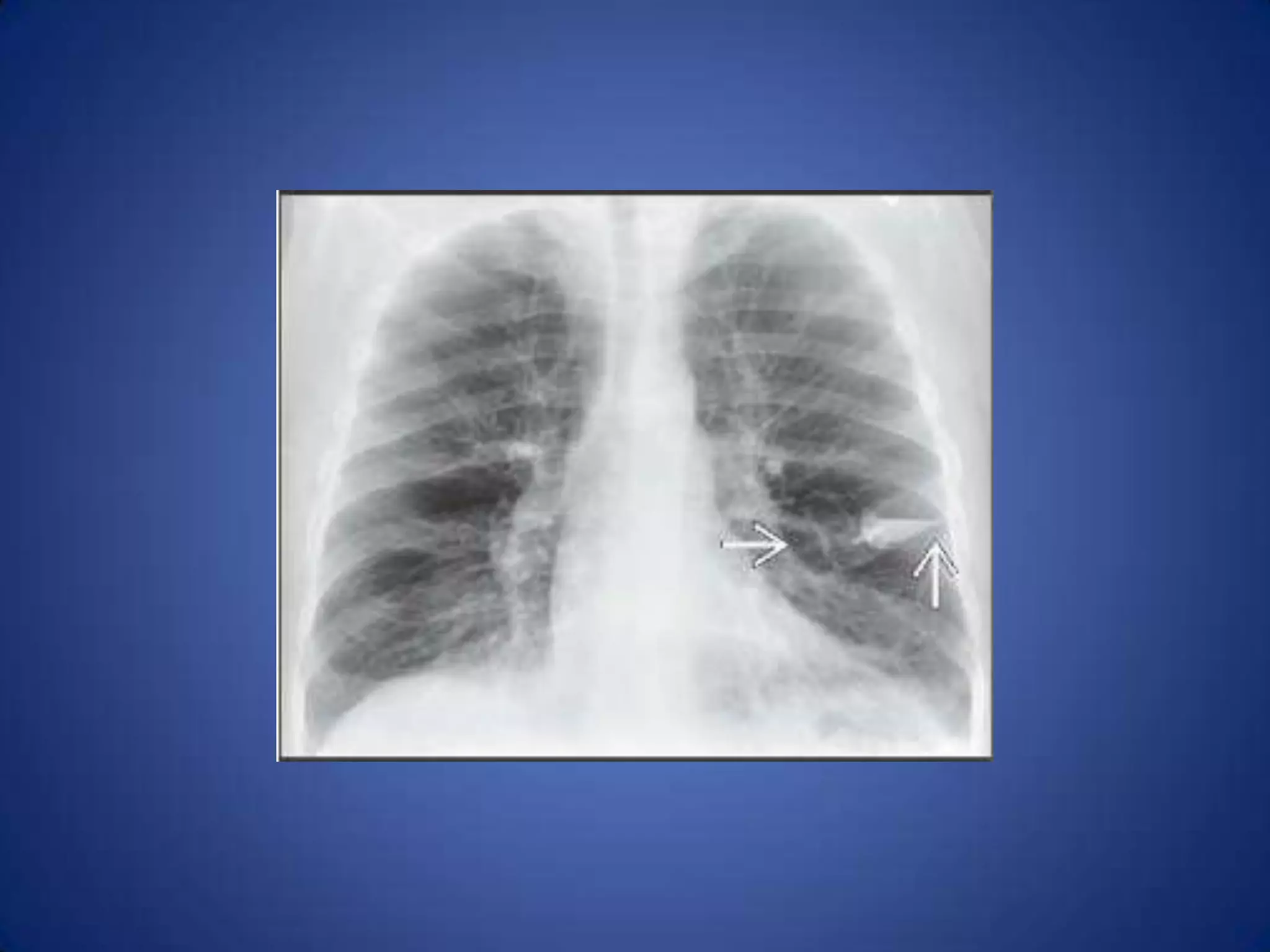 Bilateral hyperlucent hemithorax | PDF