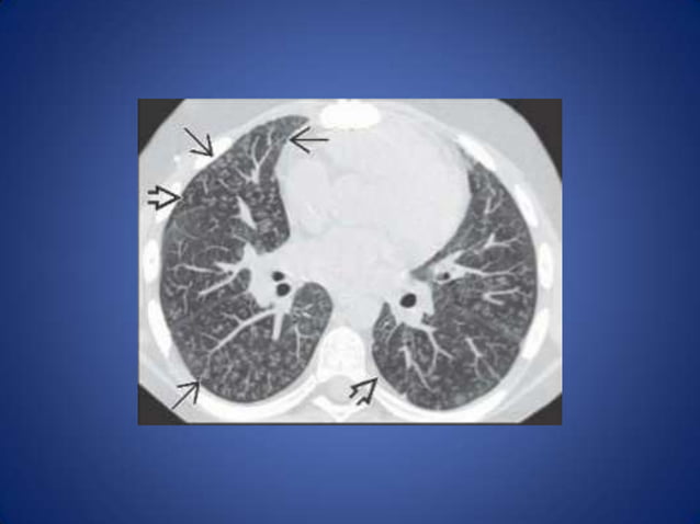 Bilateral hyperlucent hemithorax | PDF