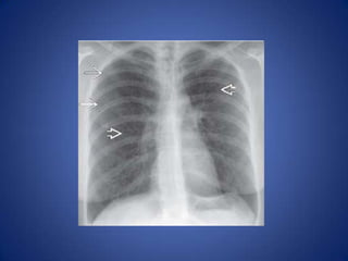 Bilateral hyperlucent hemithorax | PDF