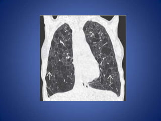 Bilateral hyperlucent hemithorax | PDF