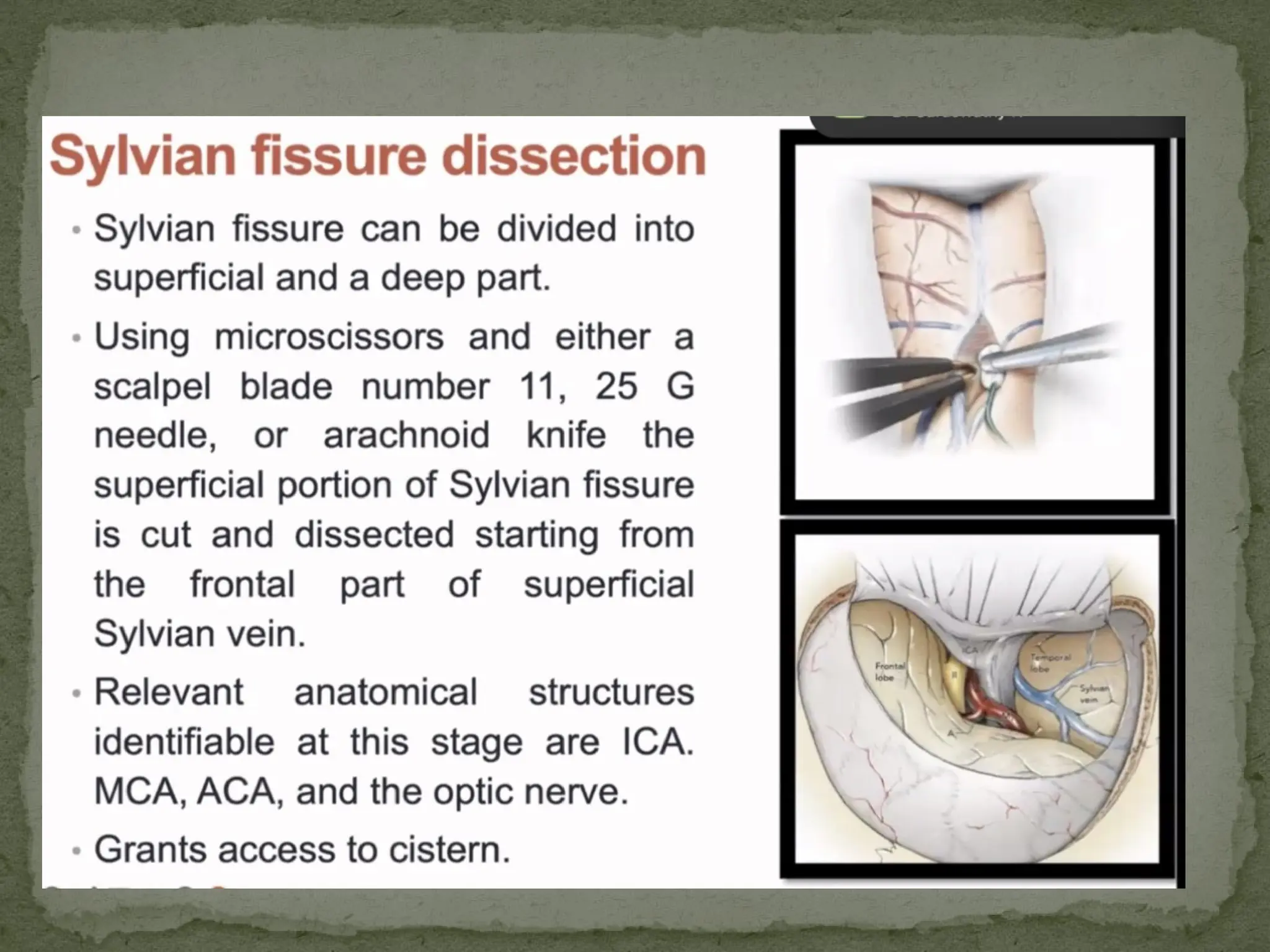 BILATERAL MCA ANEURYSM CLIPPING......... | PPT