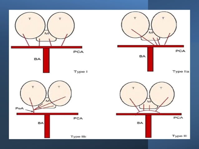 Bilateral Percheron artery occlusion, two cases | PPT Bilateral Percheron artery occlusion, two cases | PPT
