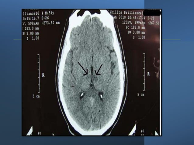 Bilateral Percheron artery occlusion, two cases | PPT