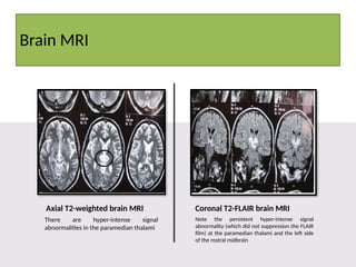 Bilateral Percheron artery occlusion, two cases | PPT