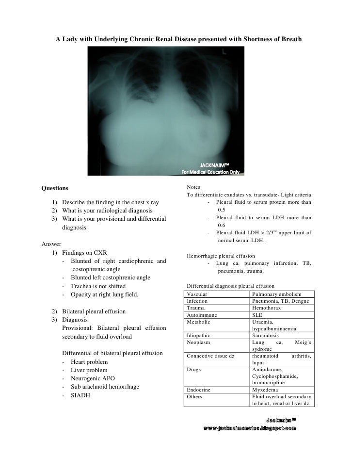 Rales lung sounds pleural effusion - unitedraser