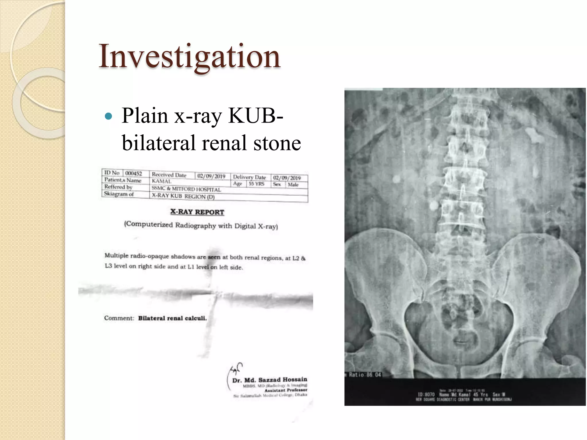 bilateral renal stone.pptx
