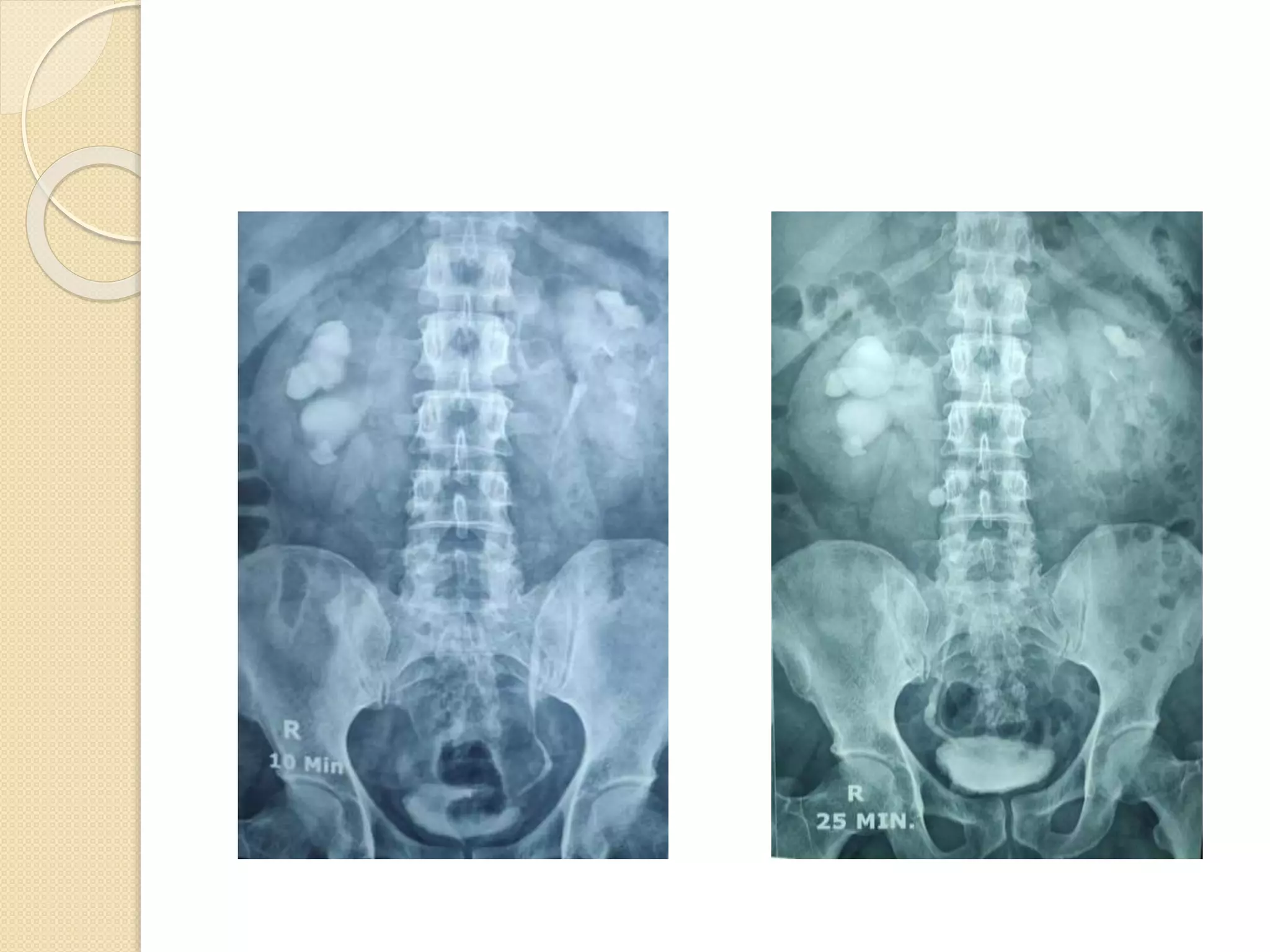 bilateral renal stone.pptx