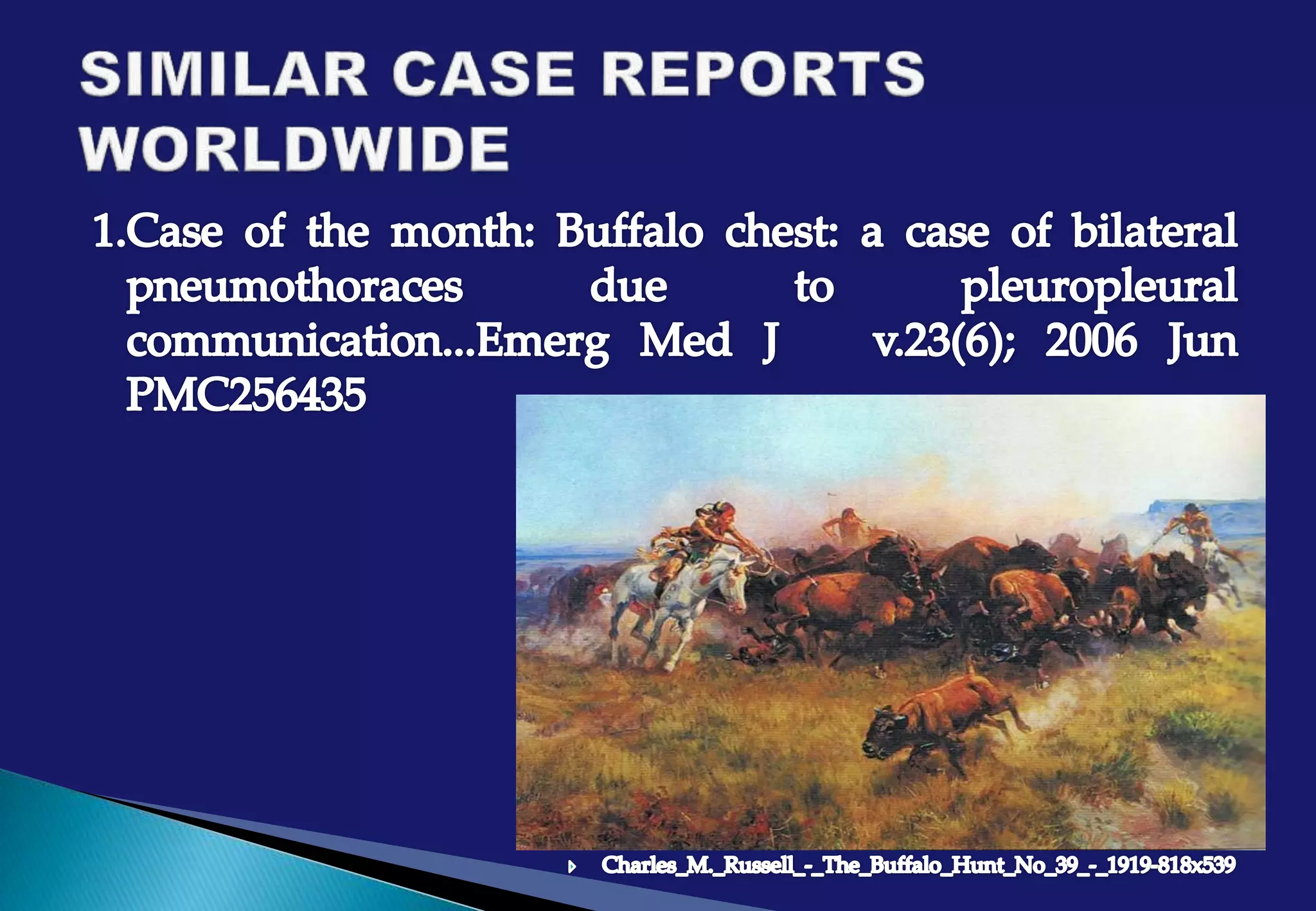 Bilateral spontaneous pnuemothoraces with pleuro pleural communication ...