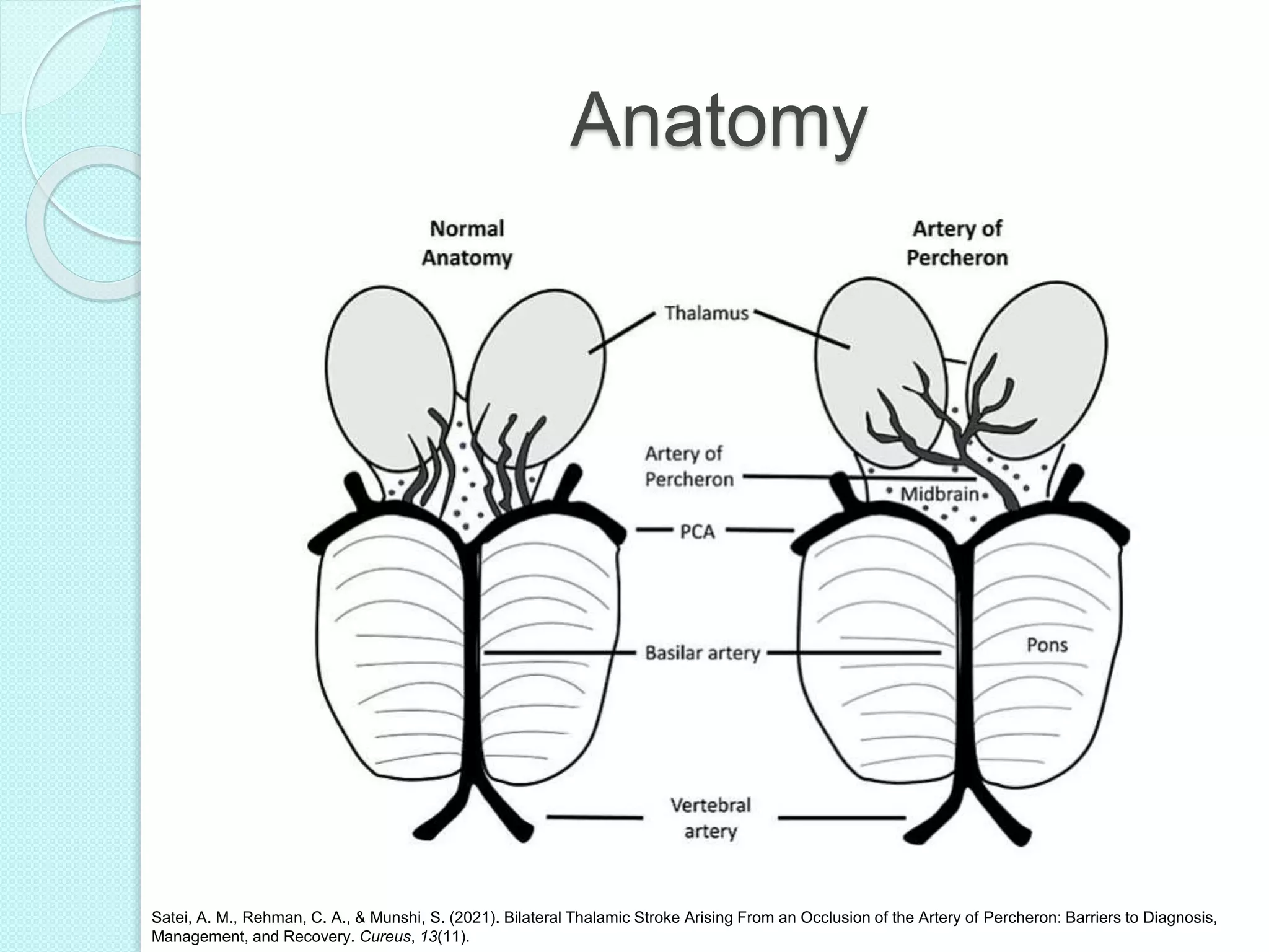 Bilateral Thalamic Infarction.pptx