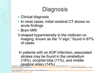 Bilateral Thalamic Infarction.pptx