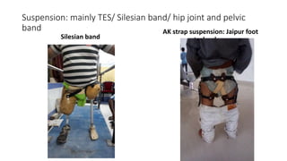 Bilateral Transfemoral amputation and stubbies (Prostheses).pptx