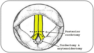 Bilateral TVC paralysis Dr. M. Erami | PDF