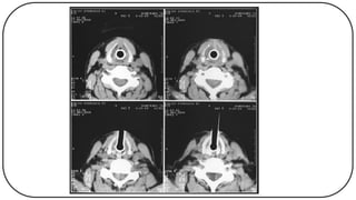 Bilateral TVC paralysis Dr. M. Erami | PDF