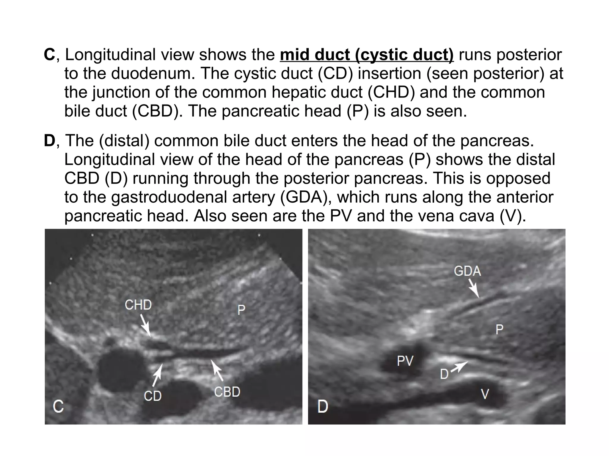 Bile duct Ultrasound | PPT