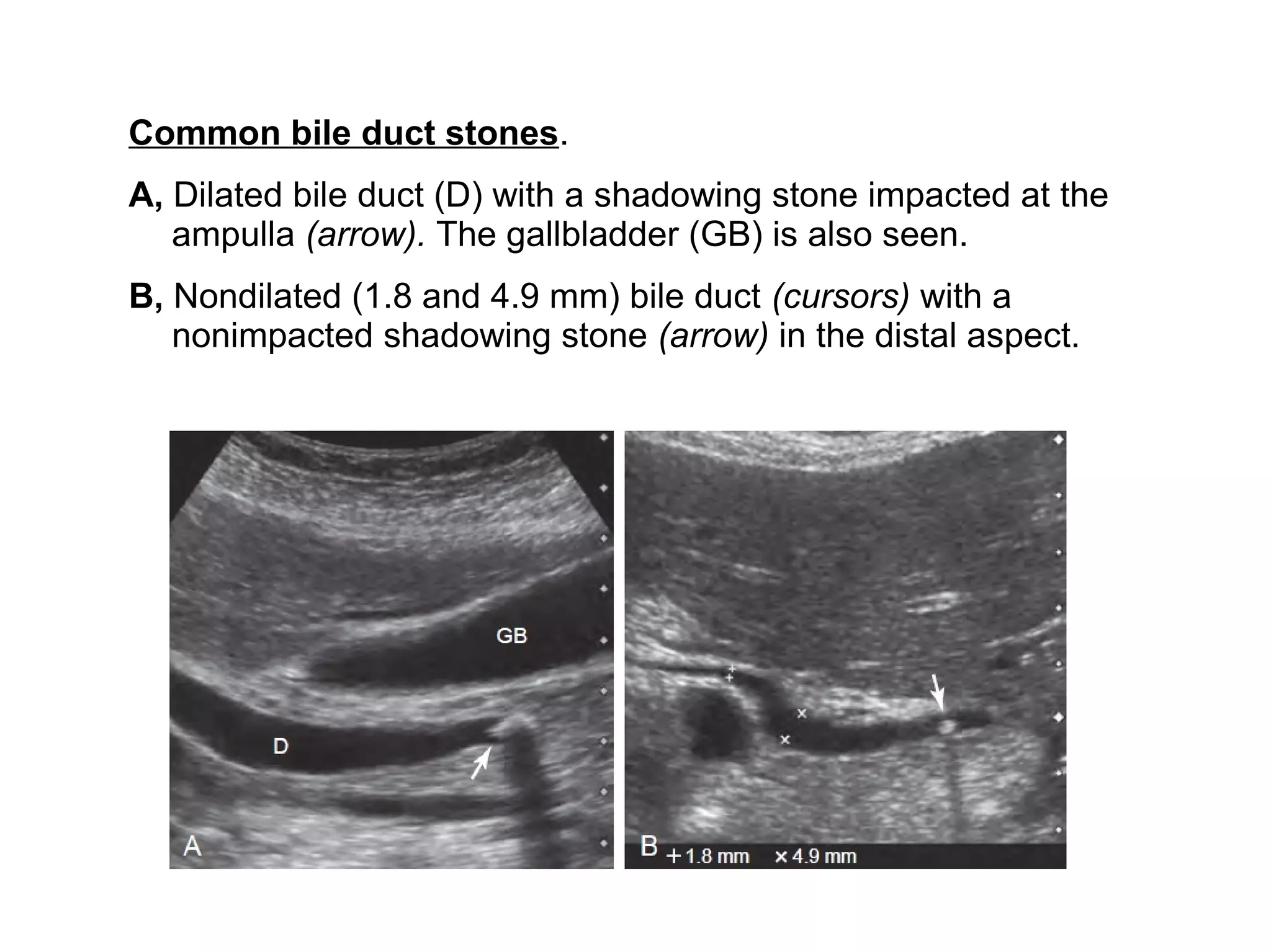 Bile Duct Ultrasound Ppt
