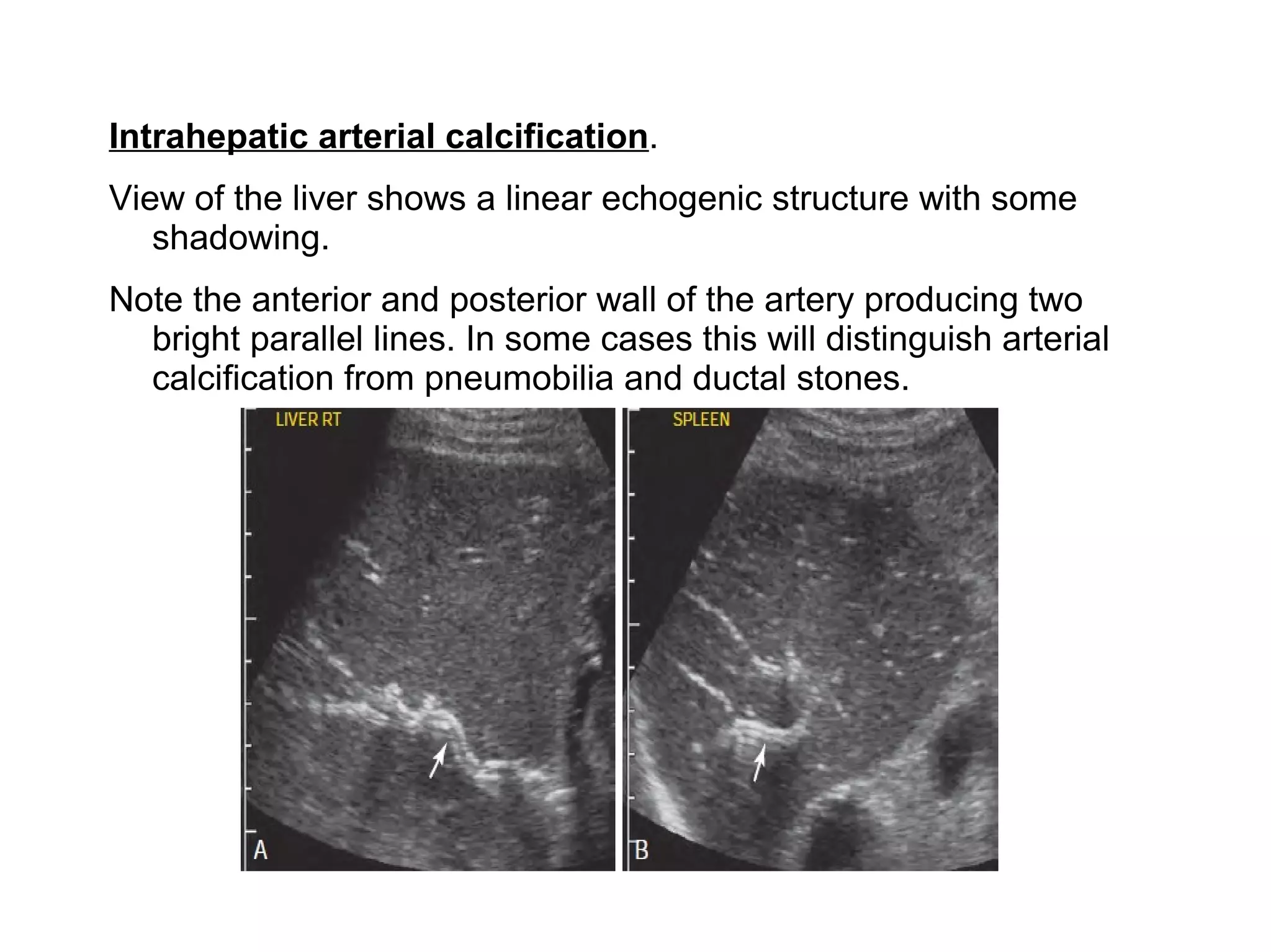 Bile duct Ultrasound | PPT