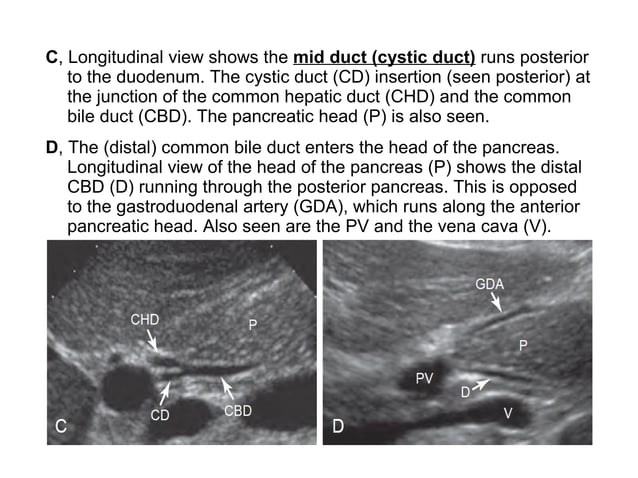 Bile Duct Ultrasound Ppt