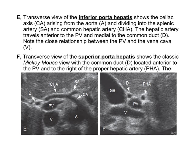 Bile Duct Ultrasound Ppt