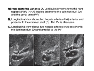 Bile duct Ultrasound | PPT