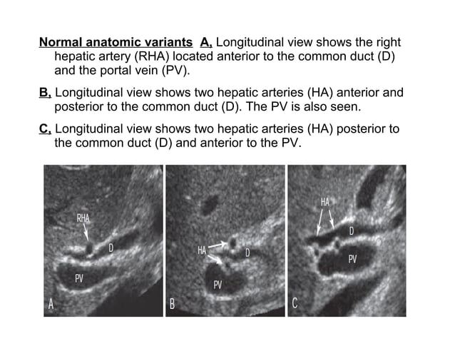 Bile Duct Ultrasound Ppt