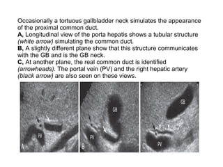 Bile duct Ultrasound | PPT