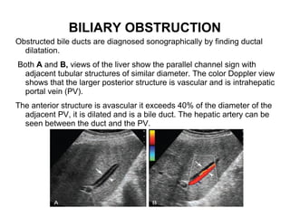 Bile duct Ultrasound | PPT