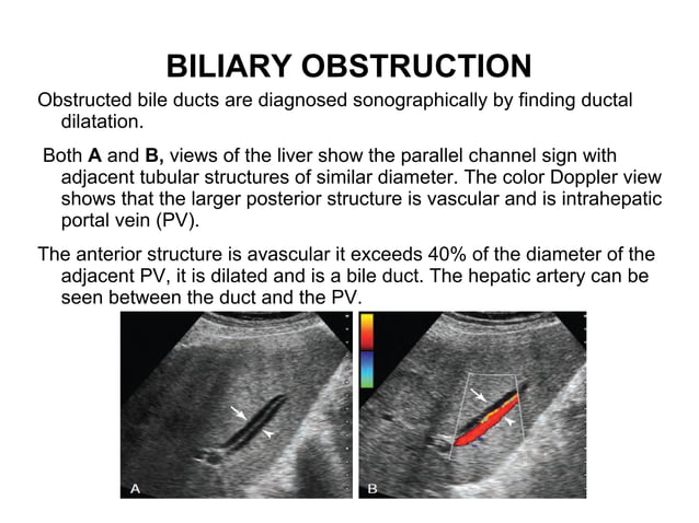 Bile Duct Ultrasound Ppt