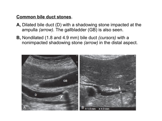 Bile Duct Ultrasound Ppt