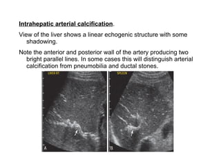 Bile duct Ultrasound | PPT