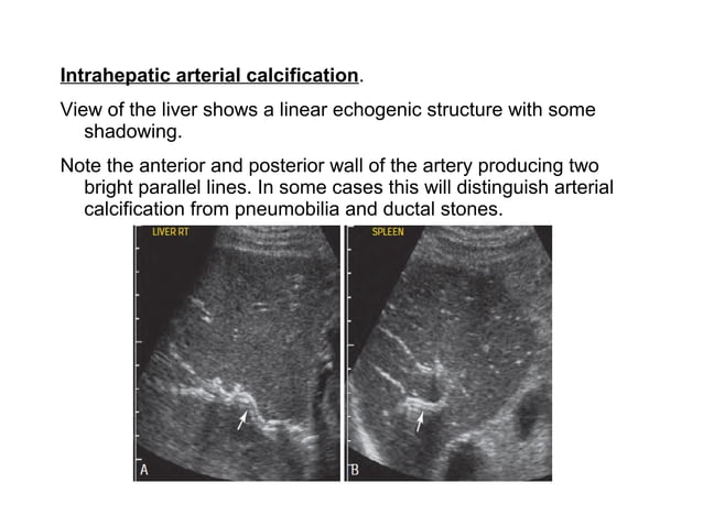 Bile Duct Ultrasound Ppt