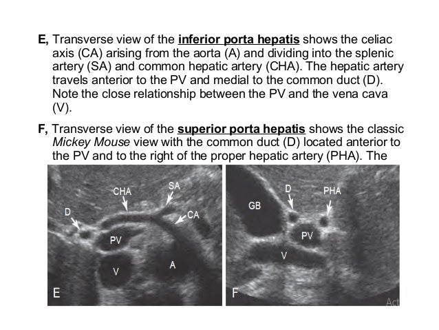 Normal Common Bile Duct Ultrasound