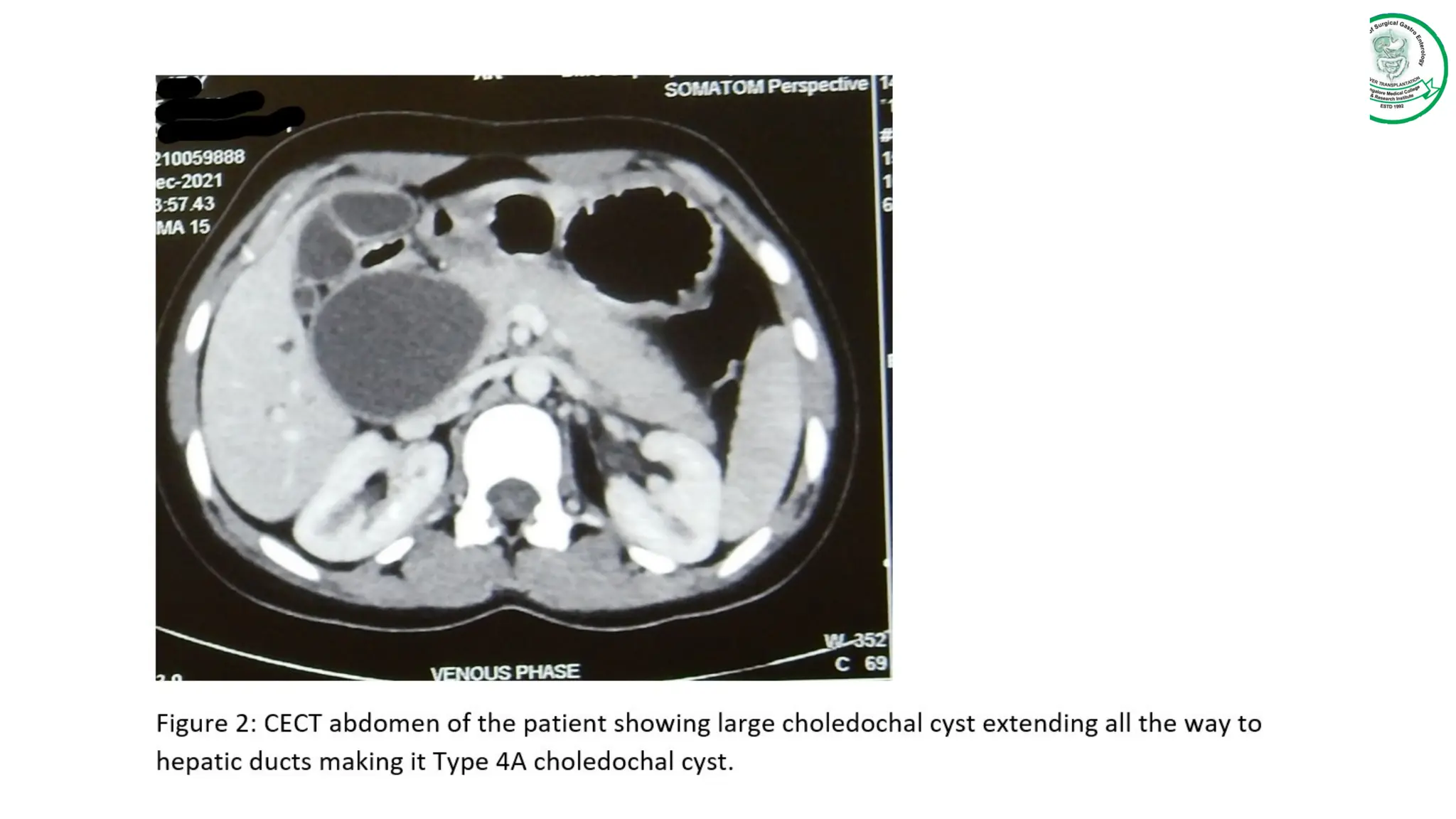 Bile duct diameter as a guide in surgical intervention of adult ...