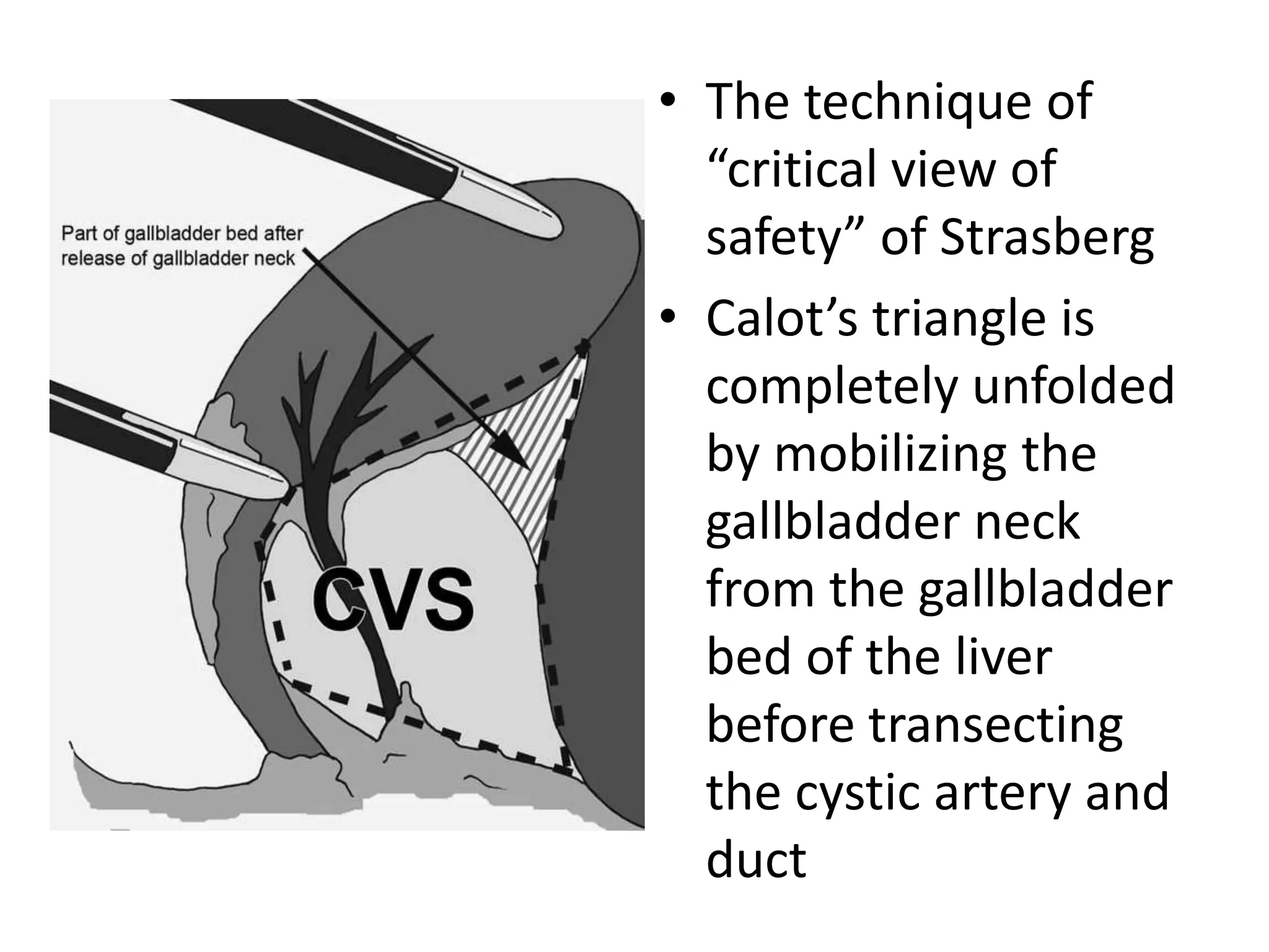 Bile duct injuries | PPSX